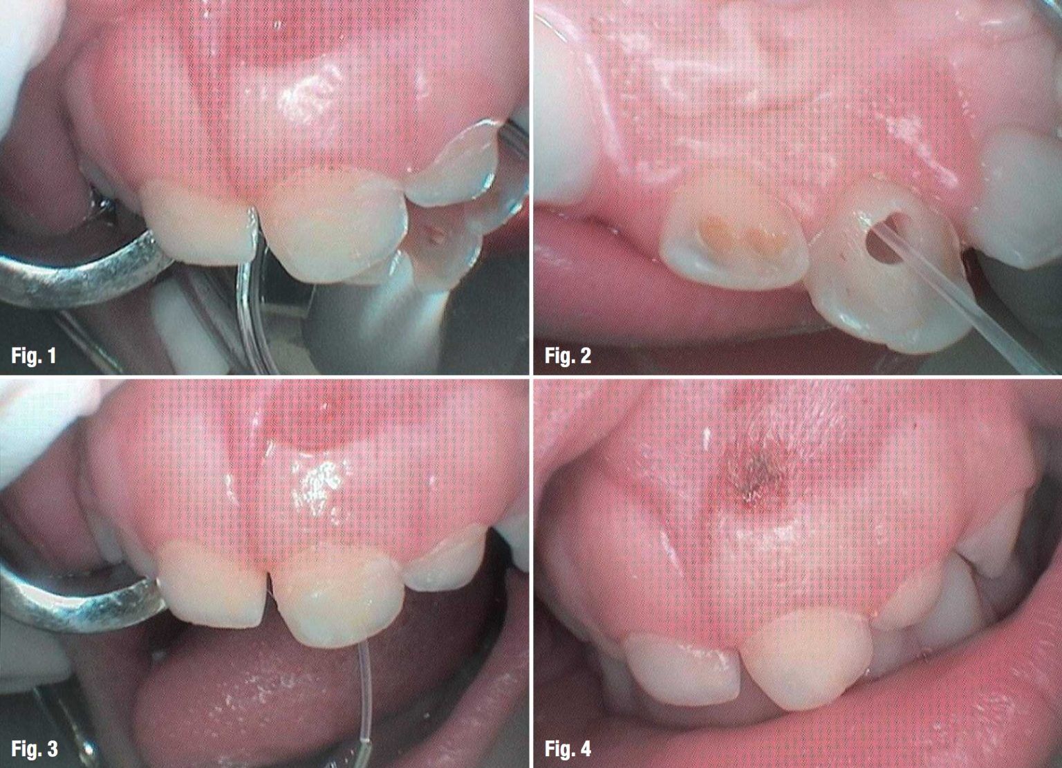 Laser-Assisted Dental Treatment to Save Baby Teeth from Extractions | Blog