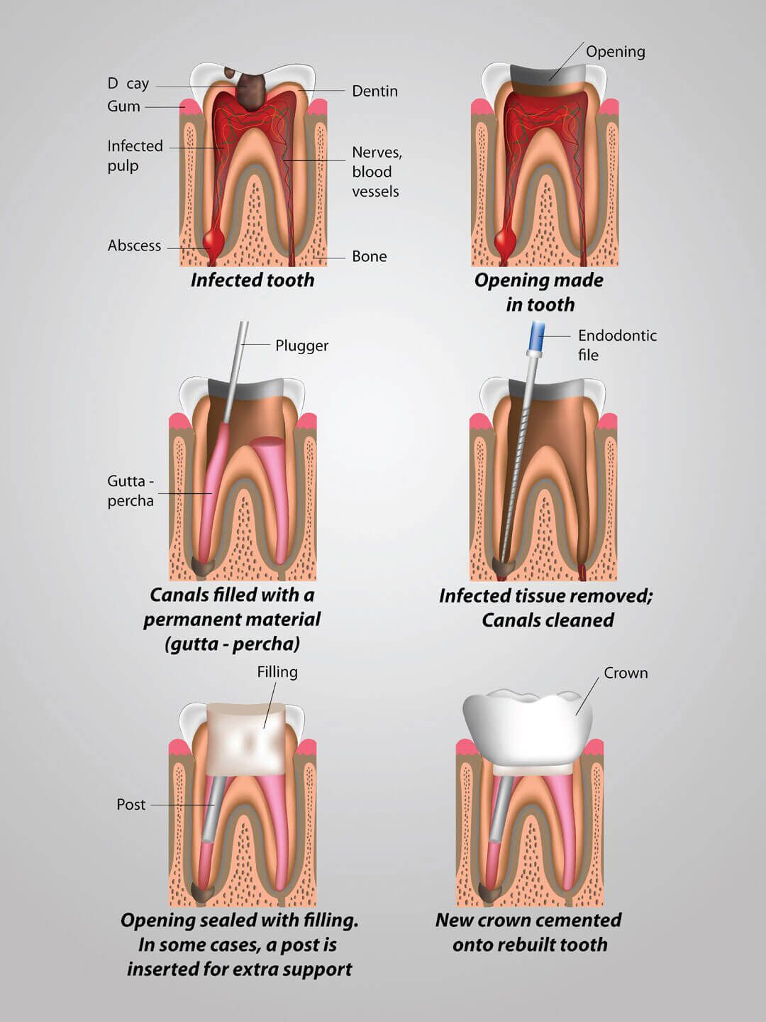 Root Canal Treatment in Dubai | Endodontist in Dubai