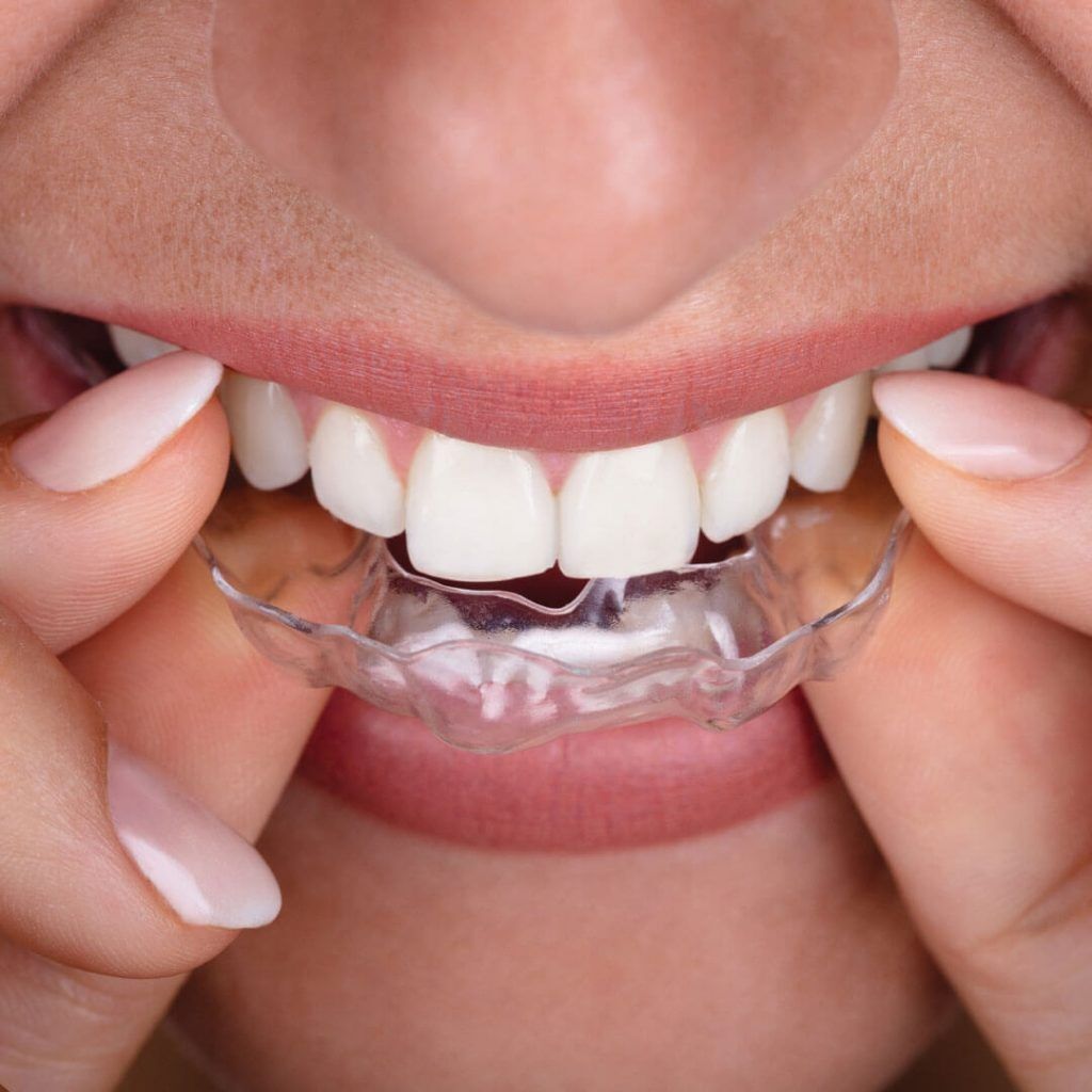 Clear aligners in Dubai - Dr Michael's Orthodontic Center