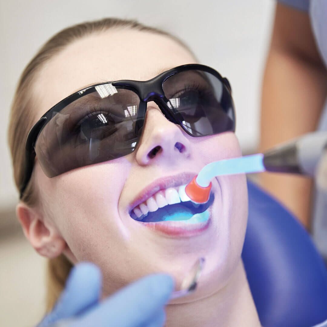 Composite Bonding in Dubai - Tooth Bonding - Dr Michaels