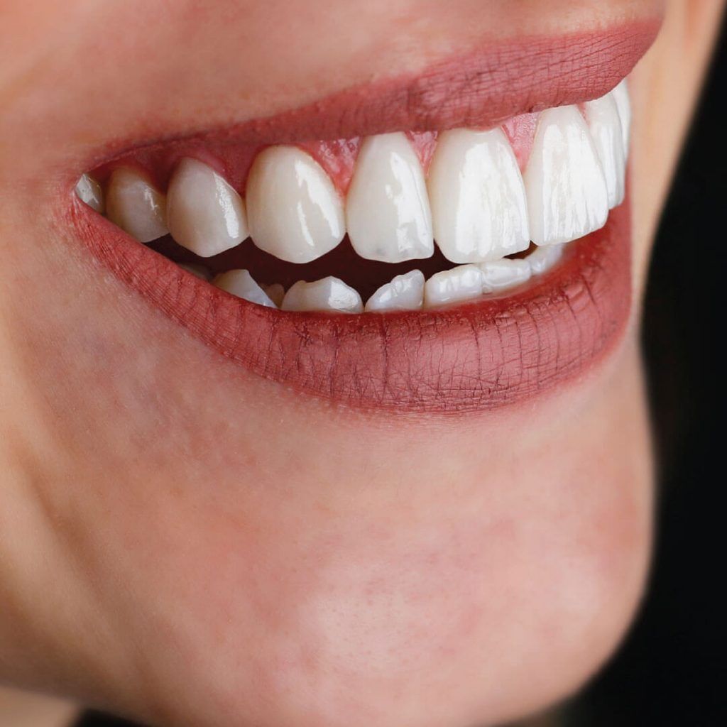 Composite Bonding in Dubai - Tooth Bonding - Dr Michaels