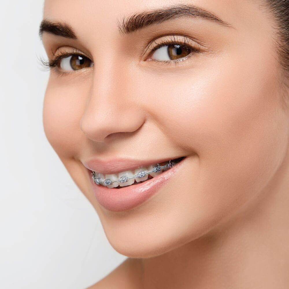 Damon Braces in Dubai - Self Ligating Clear Braces - Dr Michael's