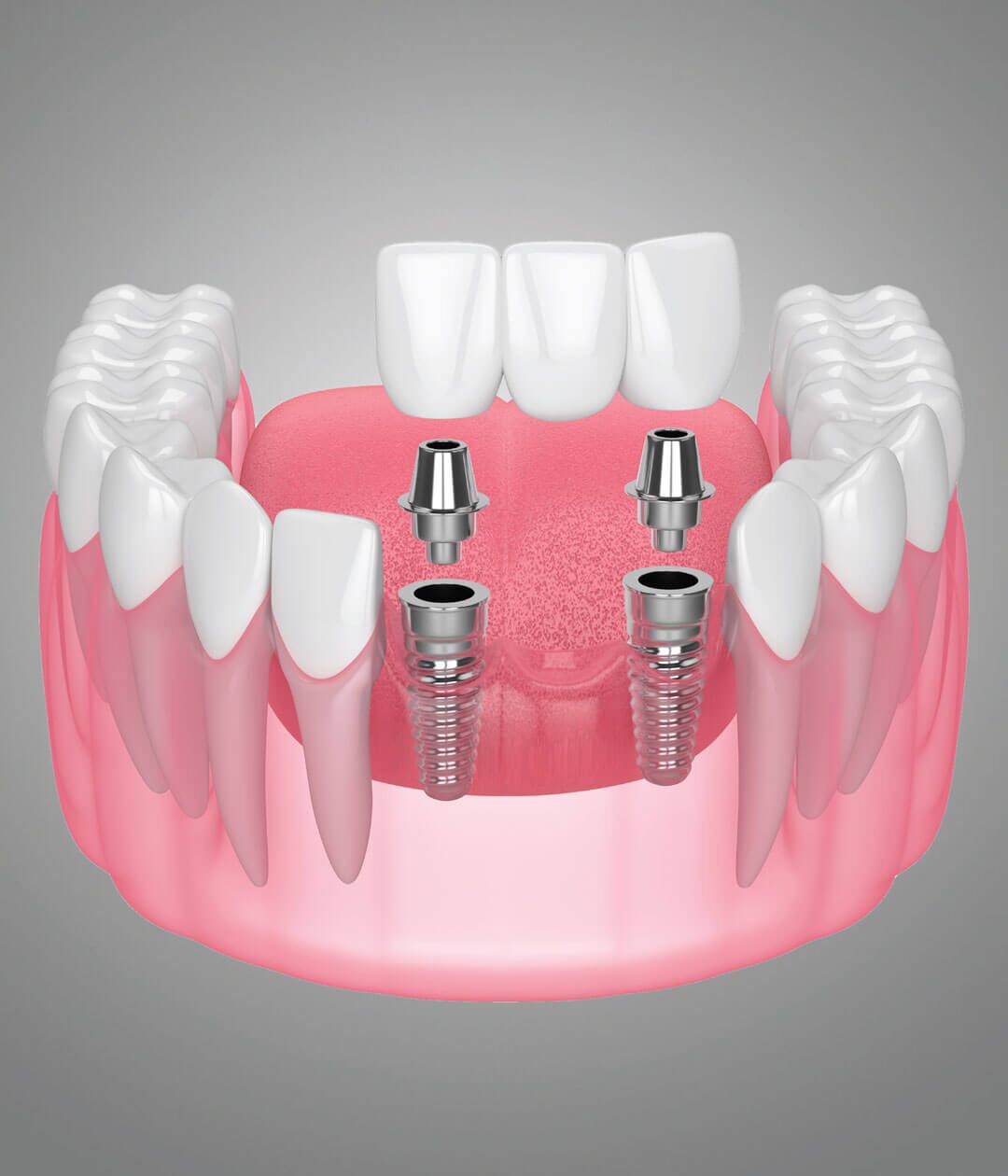 Dental Bridges in Dubai - Restore Your Smile - Dr Michaels