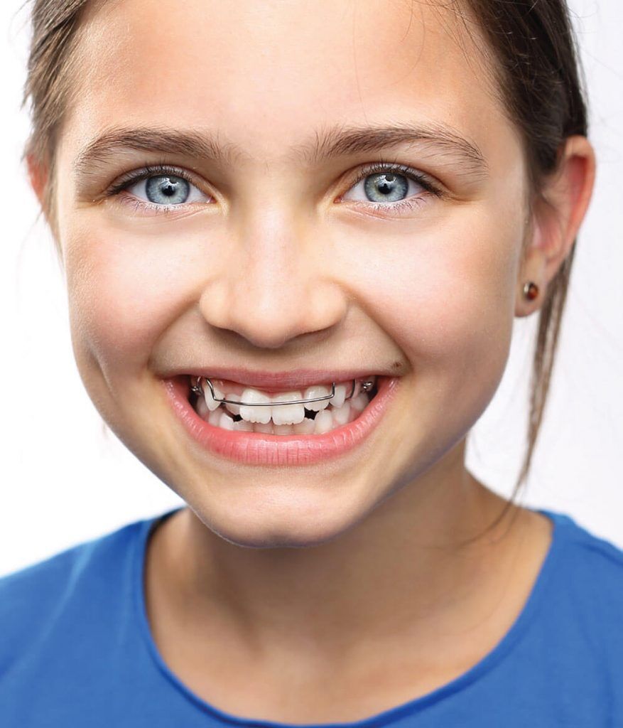 Space Maintainers for Kids in Dubai - Dr. Michael's