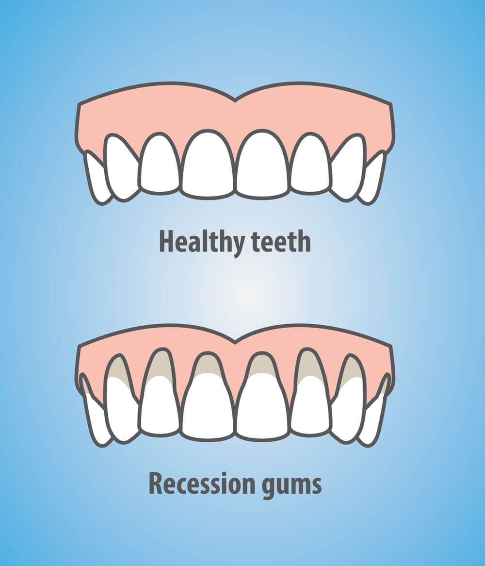 Gum Recession Treatment in Dubai - Stop Receding Gums