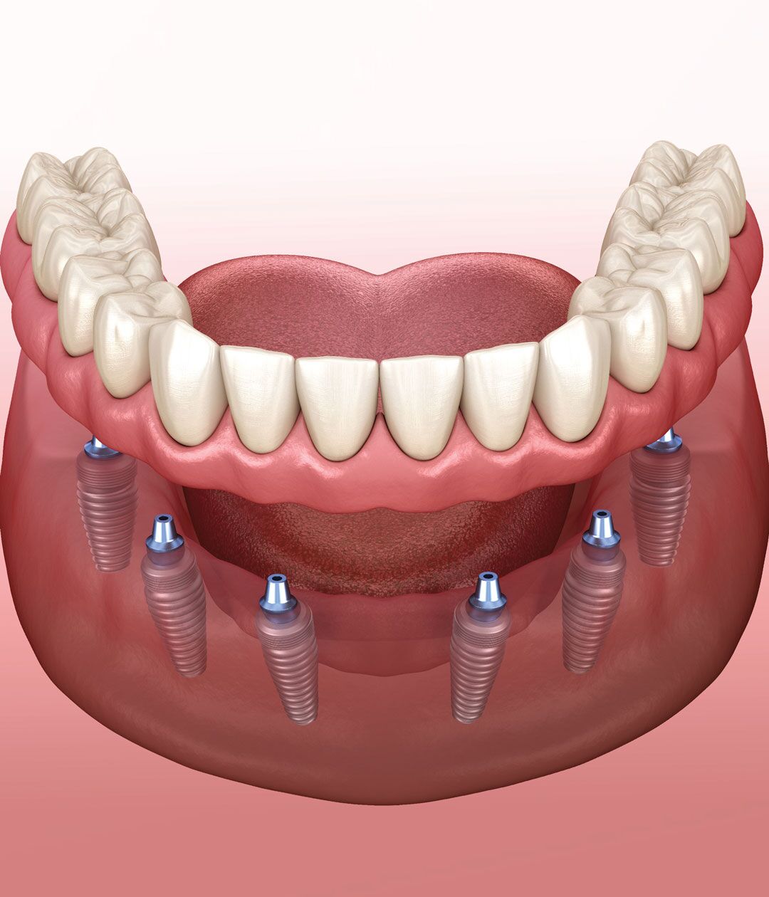 All On 6 Dental Implants in Dubai - Dr. Michael's Dental Clinic