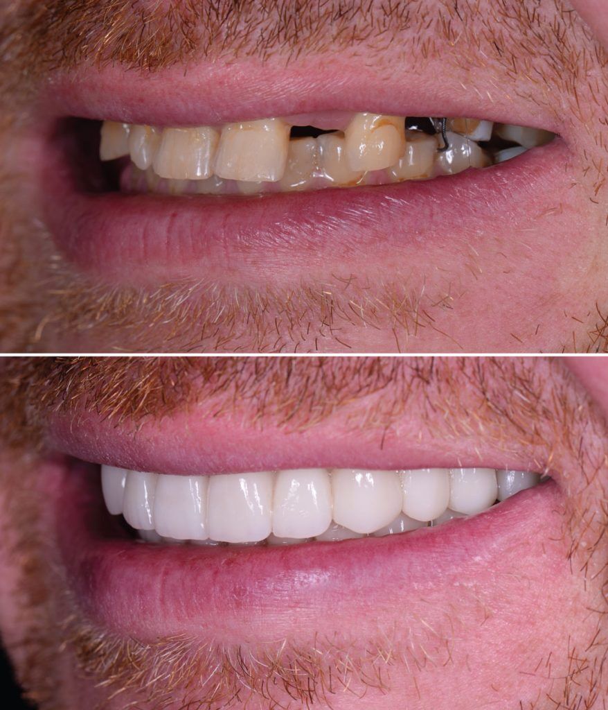 Same Day Dental Implants in Dubai - Dental Implants in A Day