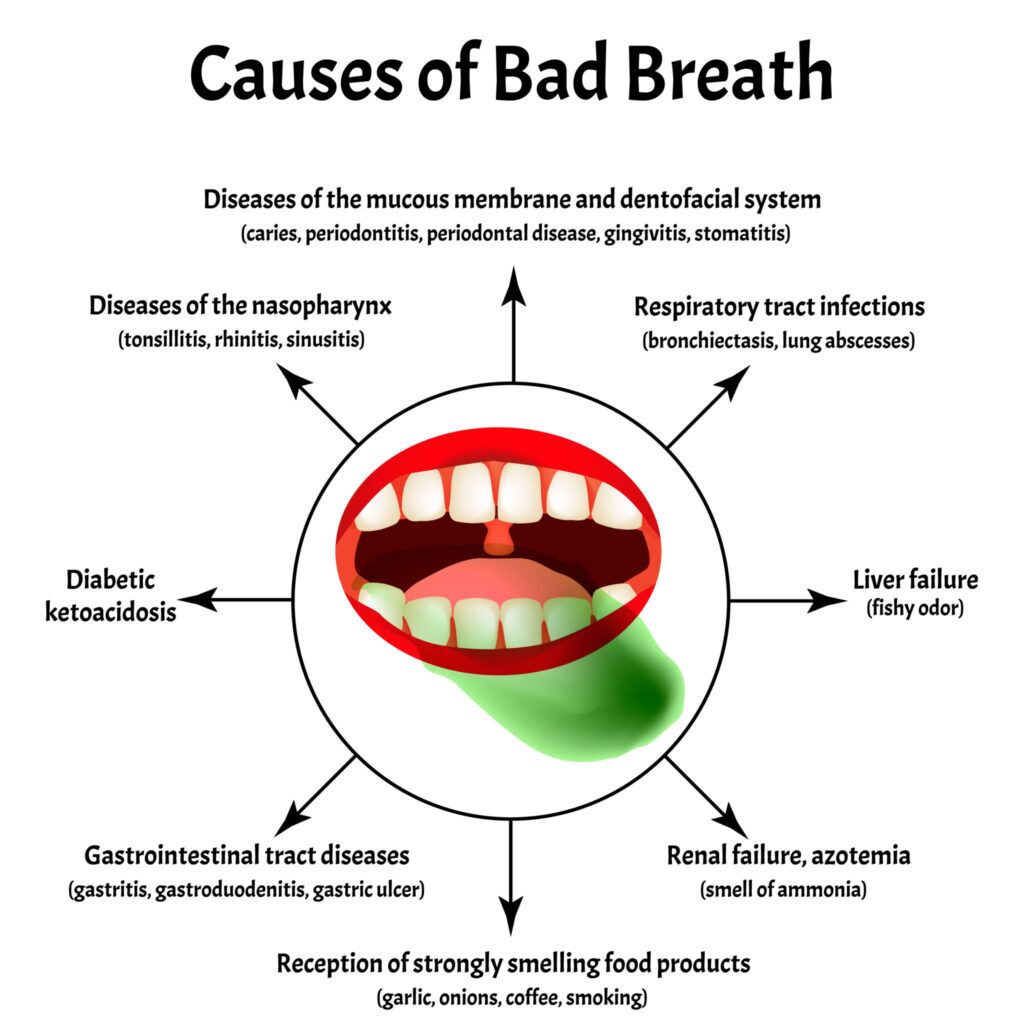 10 Ways to Eliminate Bad Breath | Causes & Treatment